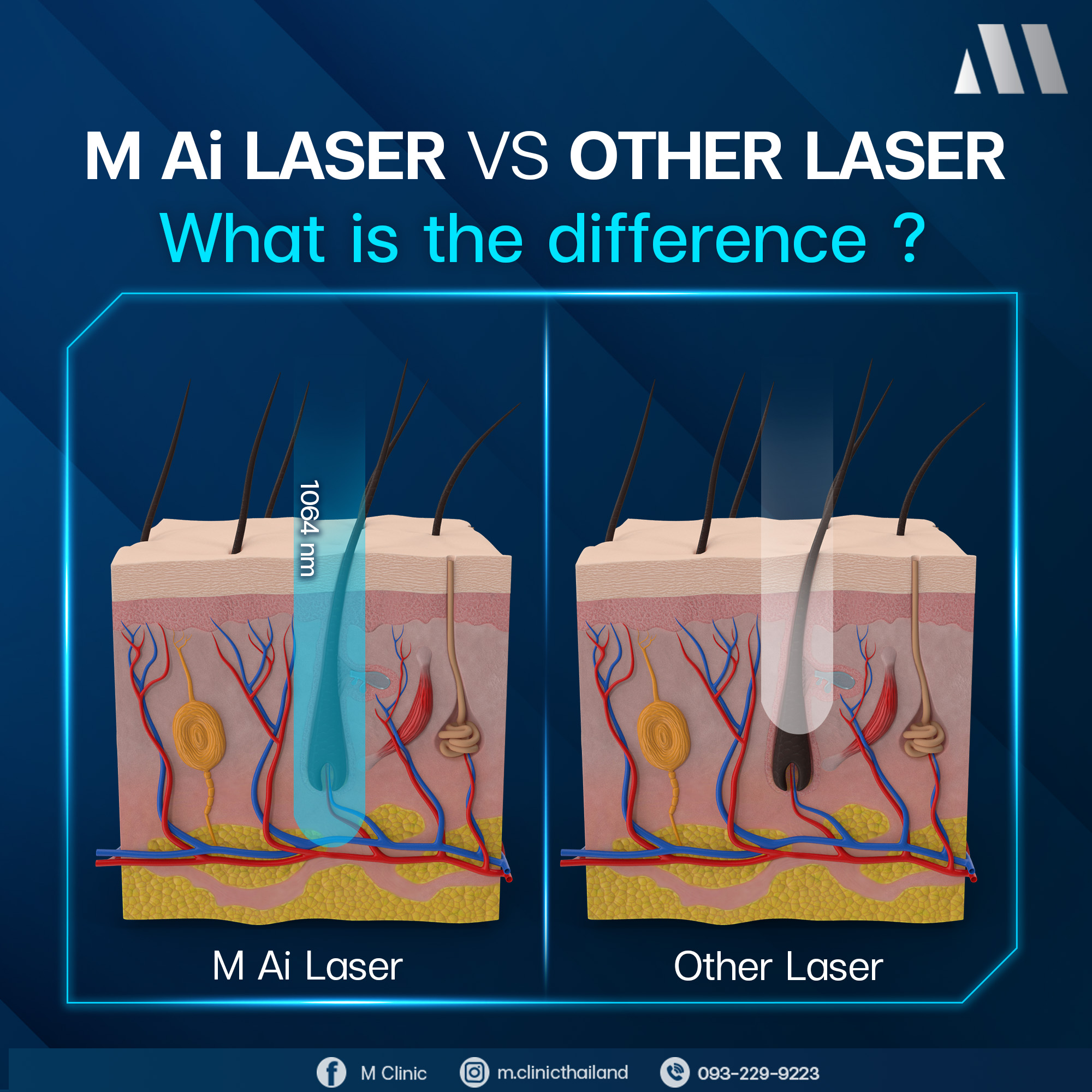 M Hair Removal - M Clinic Thailand