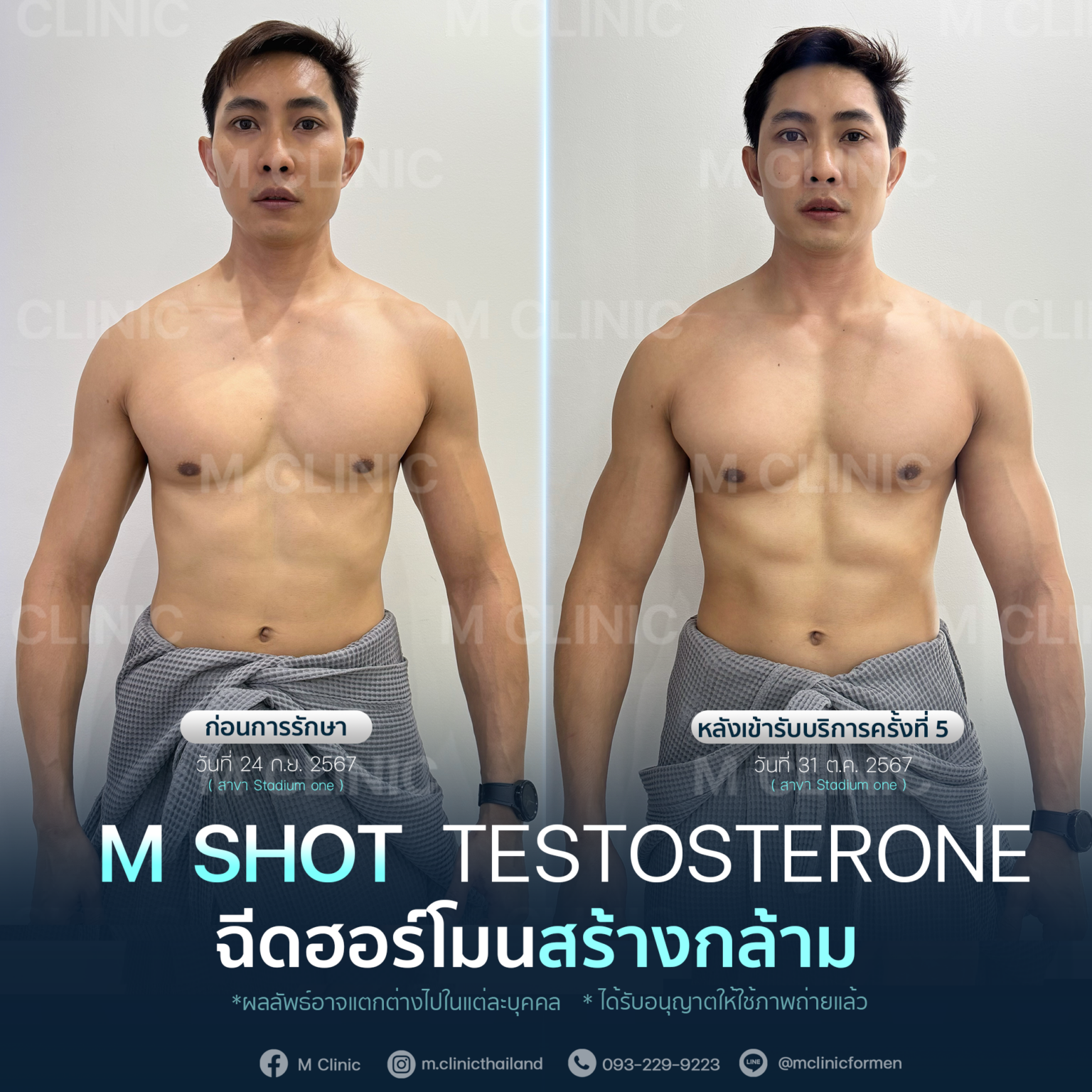 รีวิวการฉีดฮอร์โมนเพิ่มกล้ามจากคุณเบิร์ดเข้ารับบริการ M Shot ...
